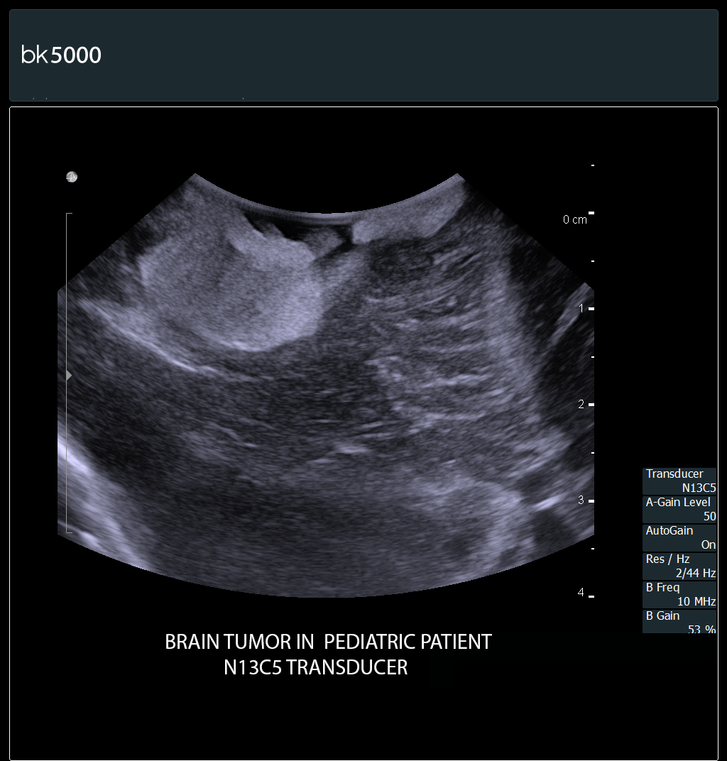 Guiding Tumor Resections In Neurosurgery With Intraoperative Ultrasound Prof Geirmund Unsgård